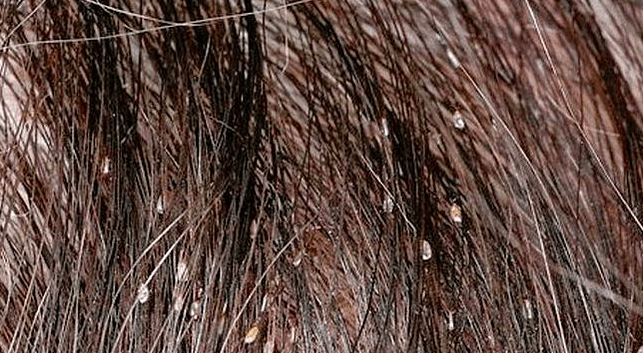 PAS OP: gemuteerde super-hoofdluis in Nederland, controleer je kinderen ...