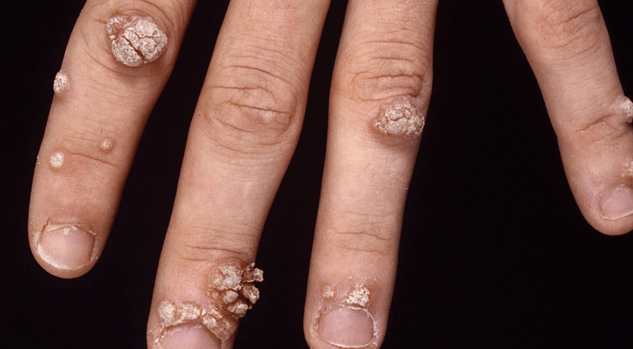 Met dit simpele middel ben je binnen 2 weken van je wratten af! Geen ...