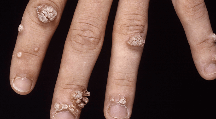 Met dit simpele middel ben je binnen 2 weken van je wratten af! Geen ...