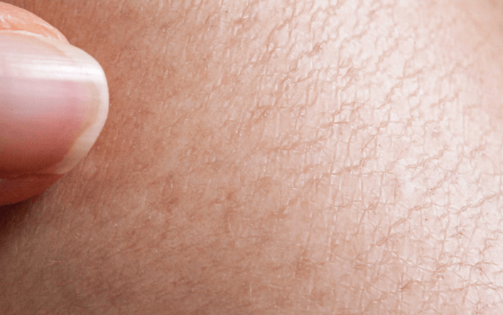 Ook zo'n last van een droge huid? Met deze trucs ben je er in een mum ...