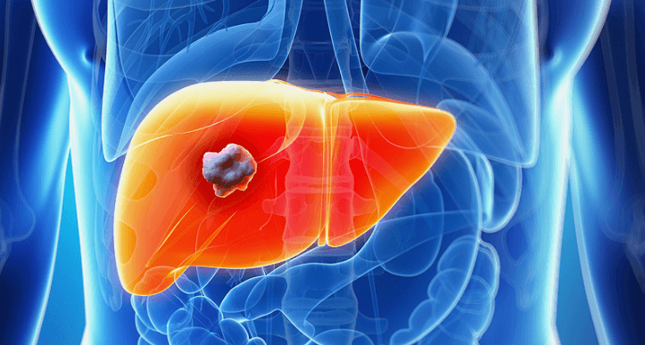 DEZE symptomen kunnen beginnende tekenen van leverkanker zijn ...
